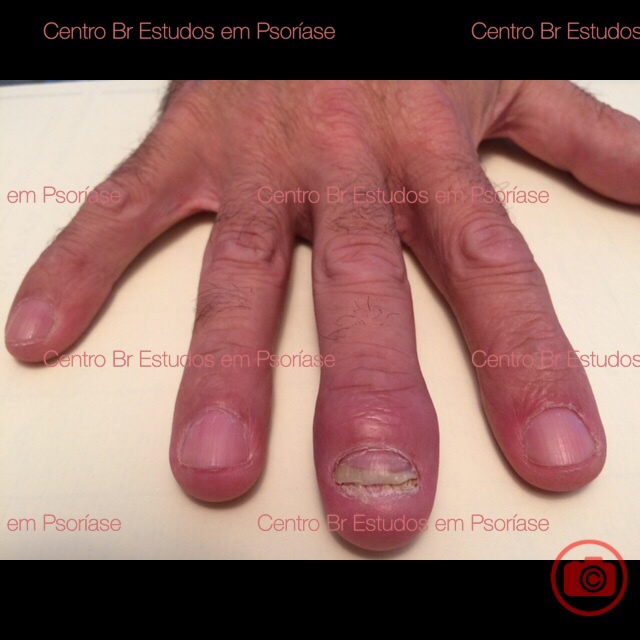 Fotos de Psoríase Artropática – Clinica Sabbag